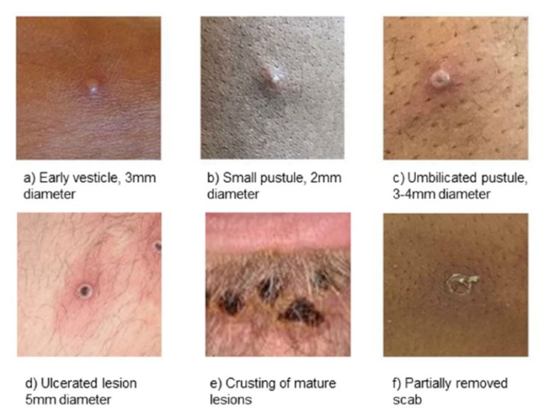 Mpox transmission and control: understanding the virus and global ...